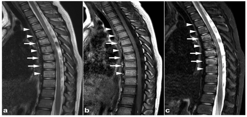 MRI of the thoracic spine - Healthcare Marketplace
